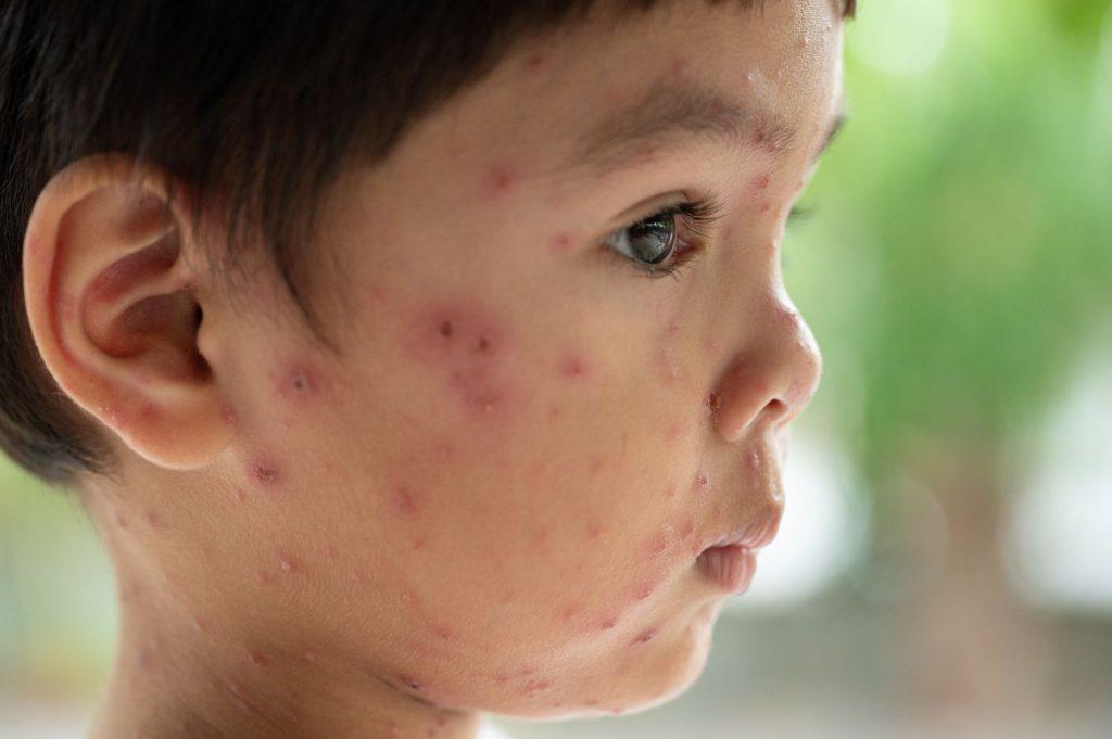 Vesirokkorokote - Rokotepalvelu - kaikki rokotuksista